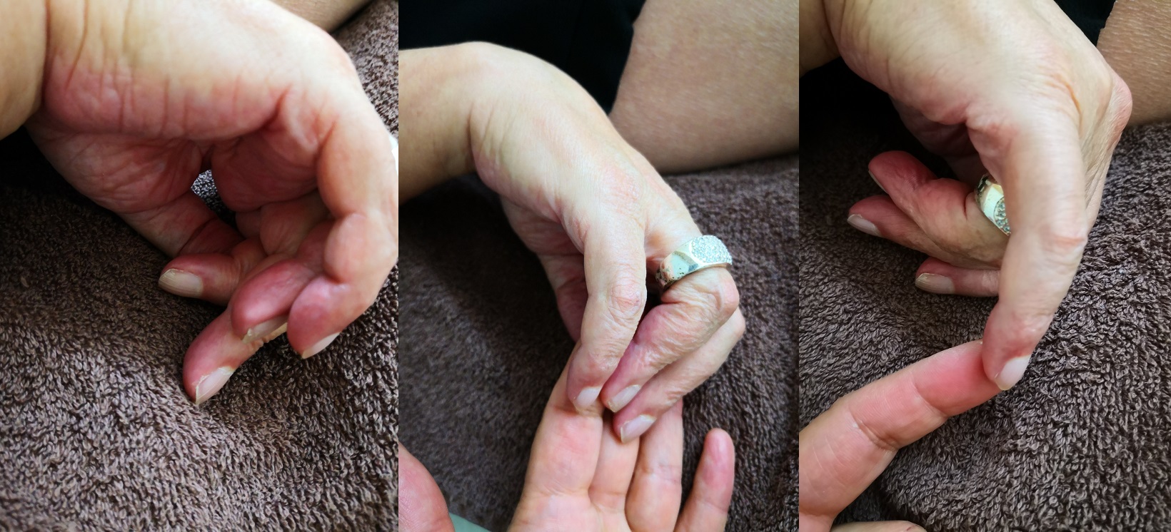 Spastik an der Hand wird entspannt • Matrix-Health-Partner Magazin