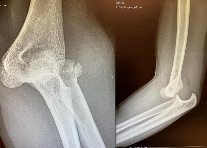 Ellenbogenluxation und Radiusköpfchenfraktur • Matrix-Health-Partner ...